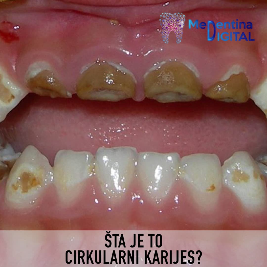 Šta je to cirkularni karijes? – MEDENTINA DIGITAL
