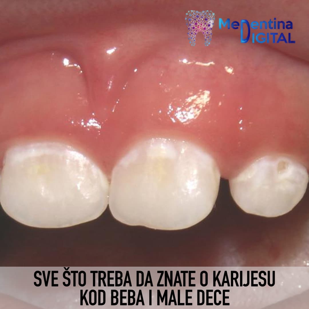 Sve što treba da znate o karijesu kod beba i male dece – MEDENTINA DIGITAL