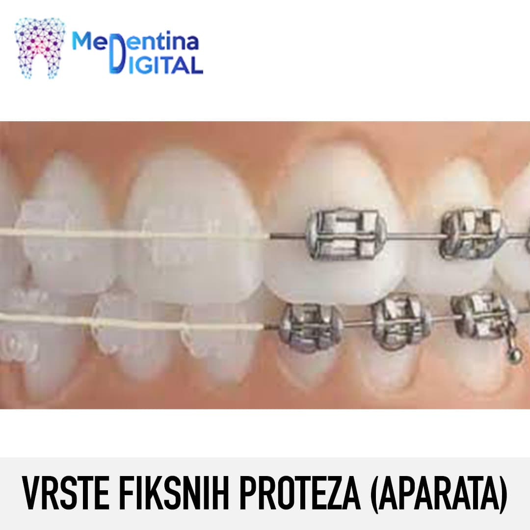 Vrste fiksnih proteza (aparata) – MEDENTINA DIGITAL