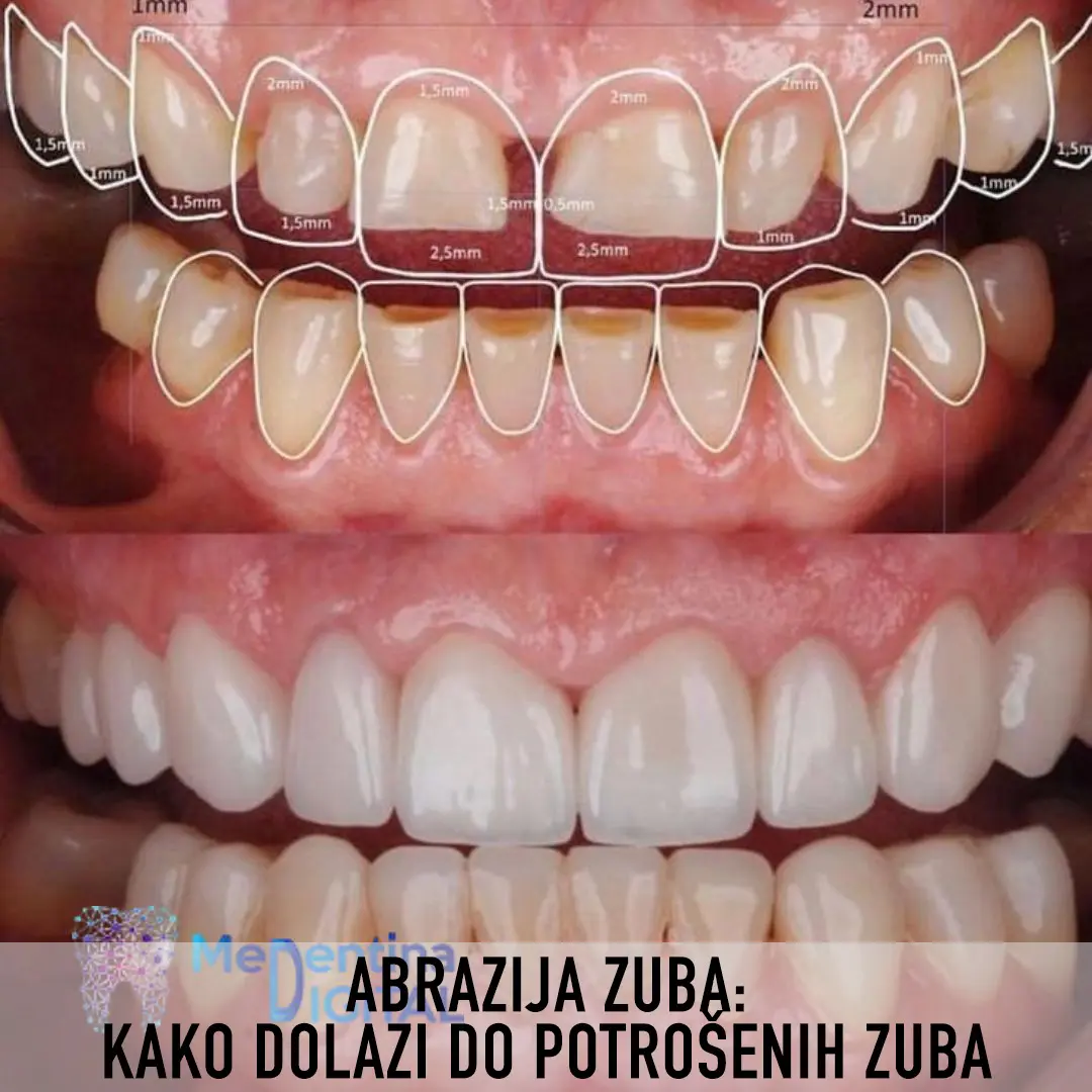Abrazija zuba: Kako dolazi do potrošenih zuba – MEDENTINA DIGITAL